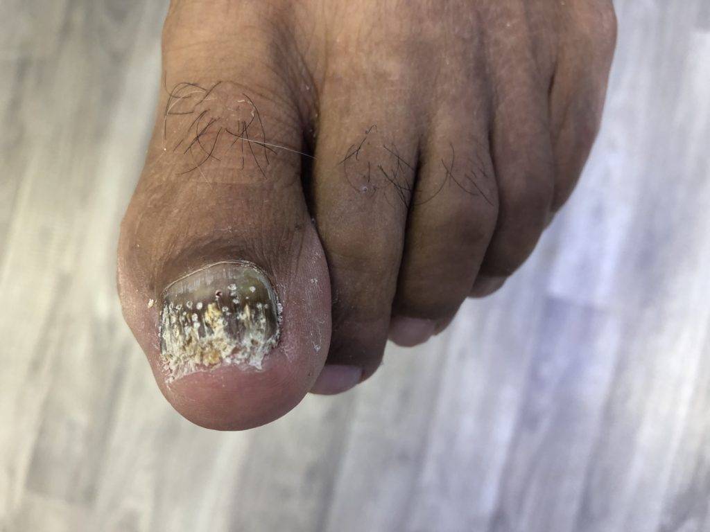 Lacuna Treatment for Fungal Nails – Kent Foot & Ankle Clinic